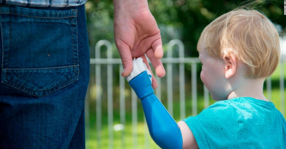 Prosthetic Hand Changes Child's Life - Engineered in UK
